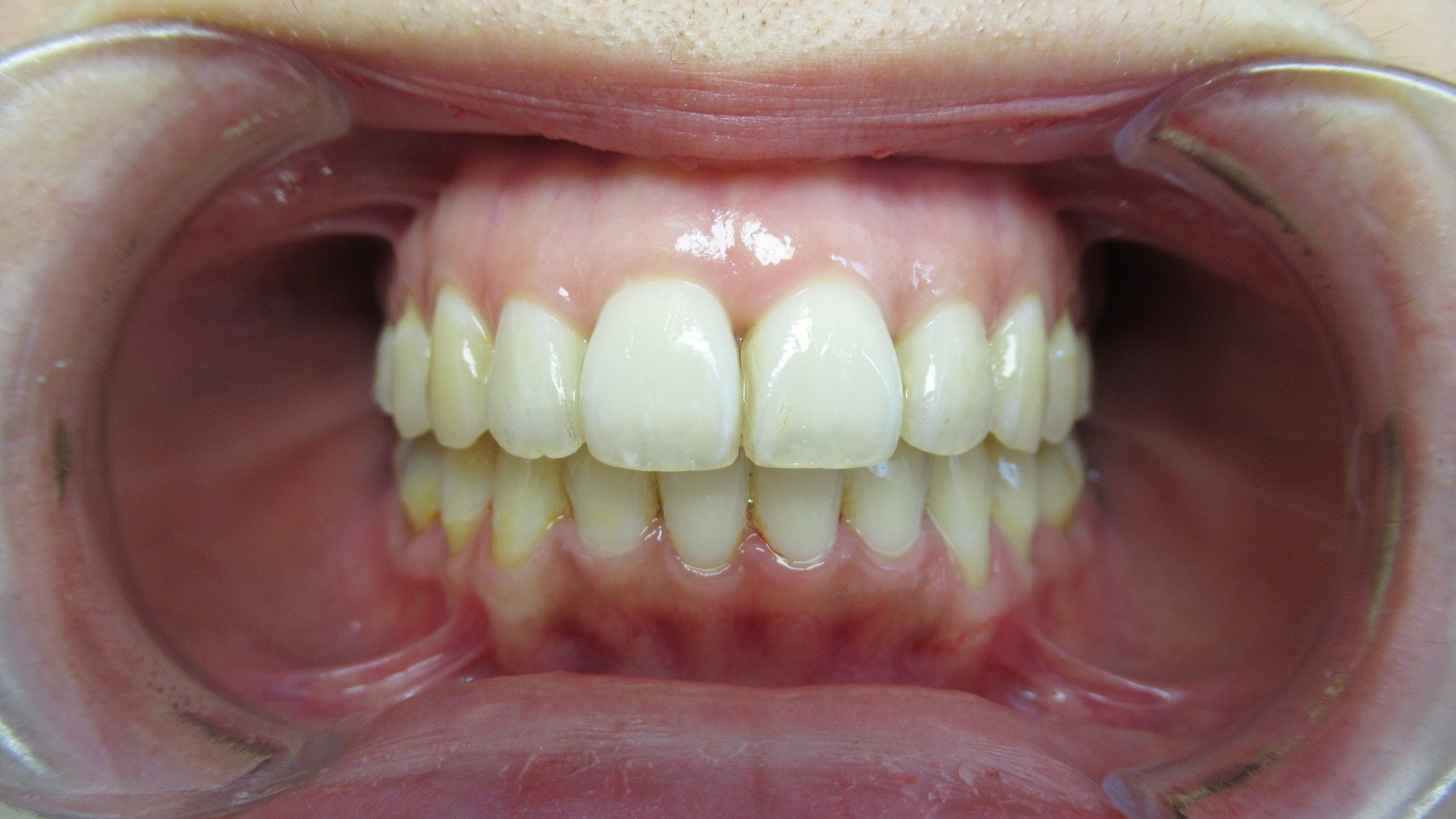 Orthodontie avant après | Centre de santé dentaire Guy Moquet Marcadet ...