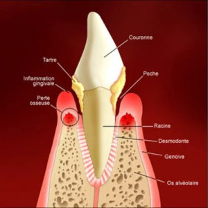 Parodontologie Paris 18 | Centre de santé dentaire Guy Moquet Marcadet